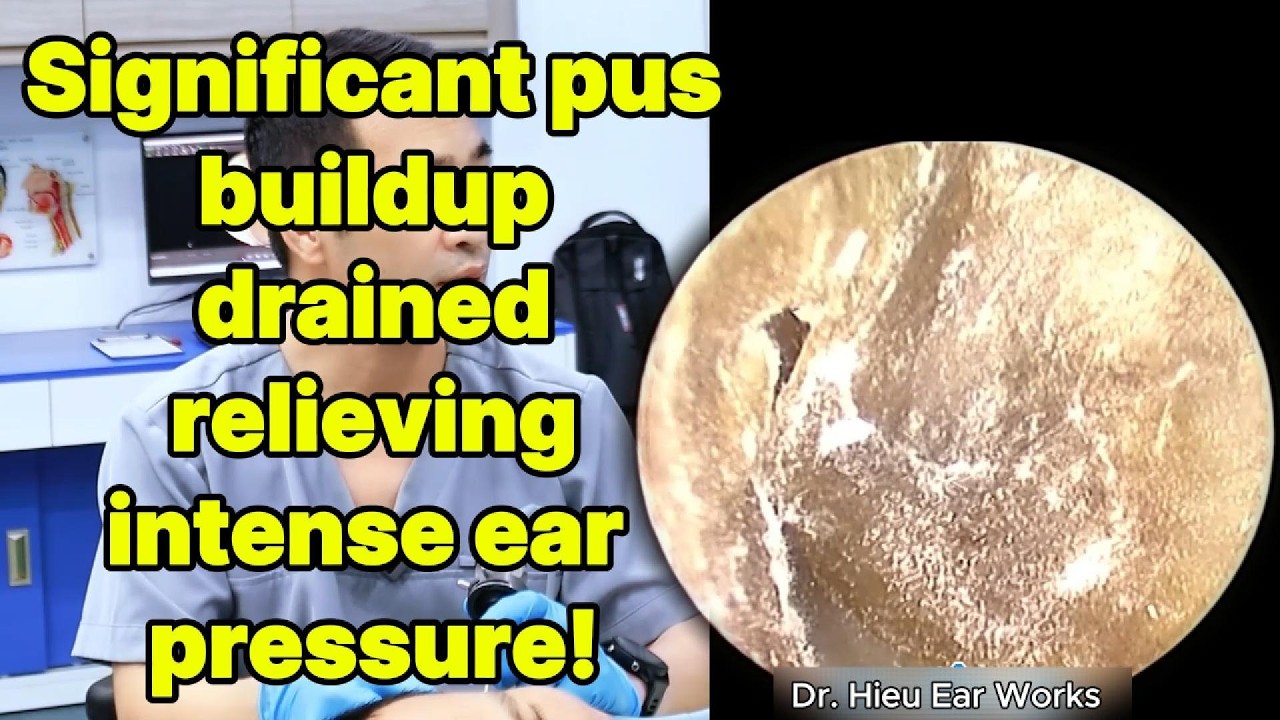 Significant pus buildup drained relieving intense | ear cleaning | ASMR ...