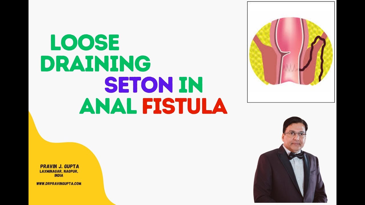 USE OF A LOOSE SETON IN A TRANS-SPHINCTERIC FISTULA - YouTube