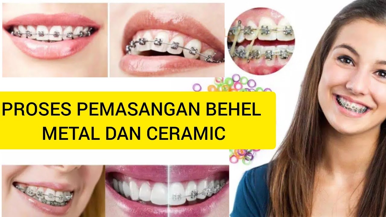 BEHEL GIGI METAL DAN CERAMIC. PROSES PEMASANGAN BEHEL DENGAN ALAT ...