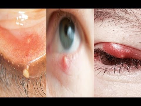 Hordeolum vs chalazion vs blepharitis - YouTube