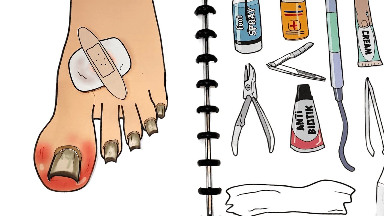 Paper ASMR Ingrown Toenail Removal Treatment | Paper Play | Satisfying ...