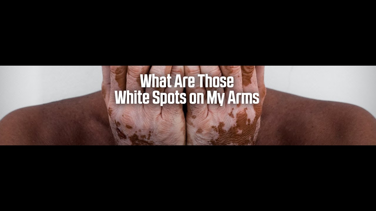 What Are Those White Spots on My Arms? - YouTube