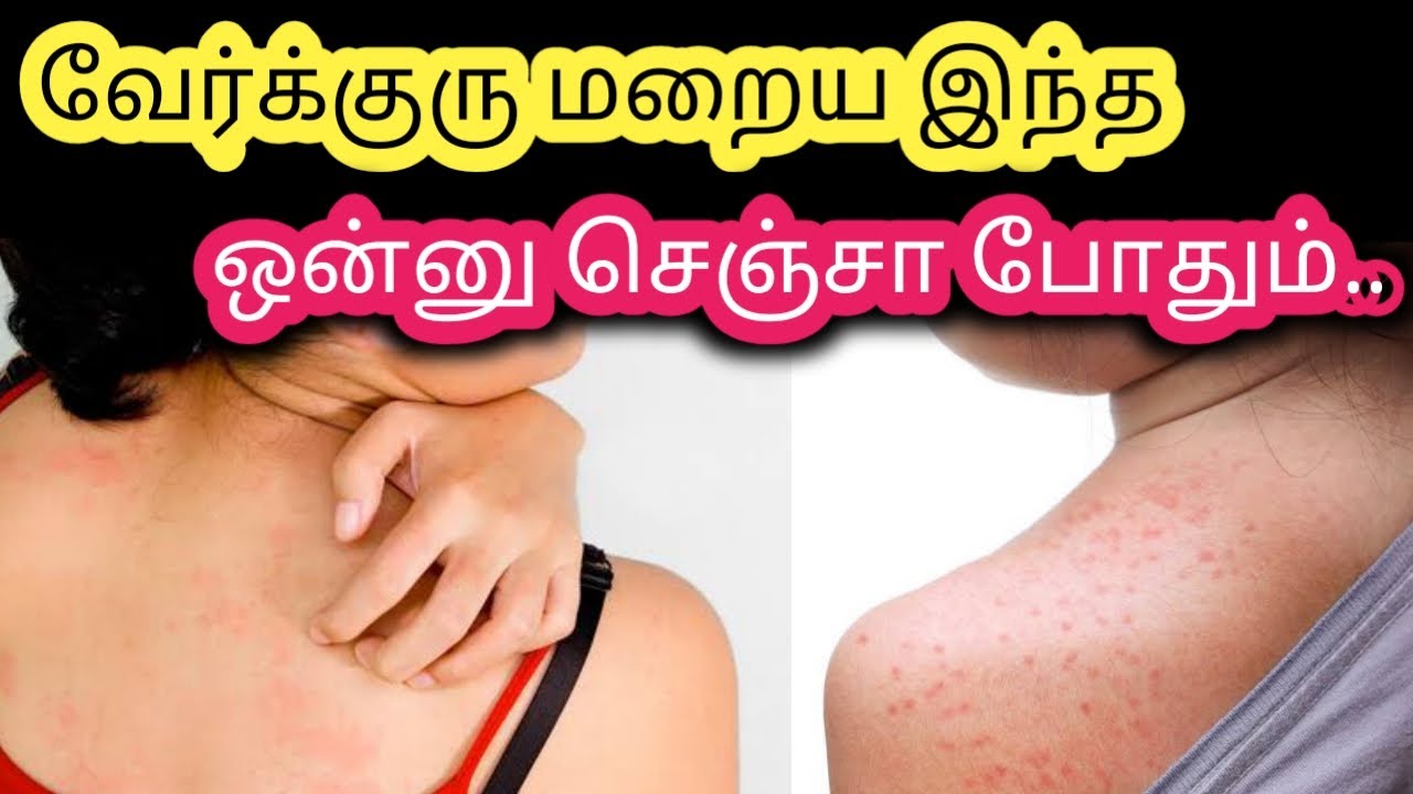 Home Remedies For Prickly Heat Verkuru Poga Tips In Tamil Treatment home-remedies-for-prickly-heat-verkuru-poga-tips-in-tamil-treatment