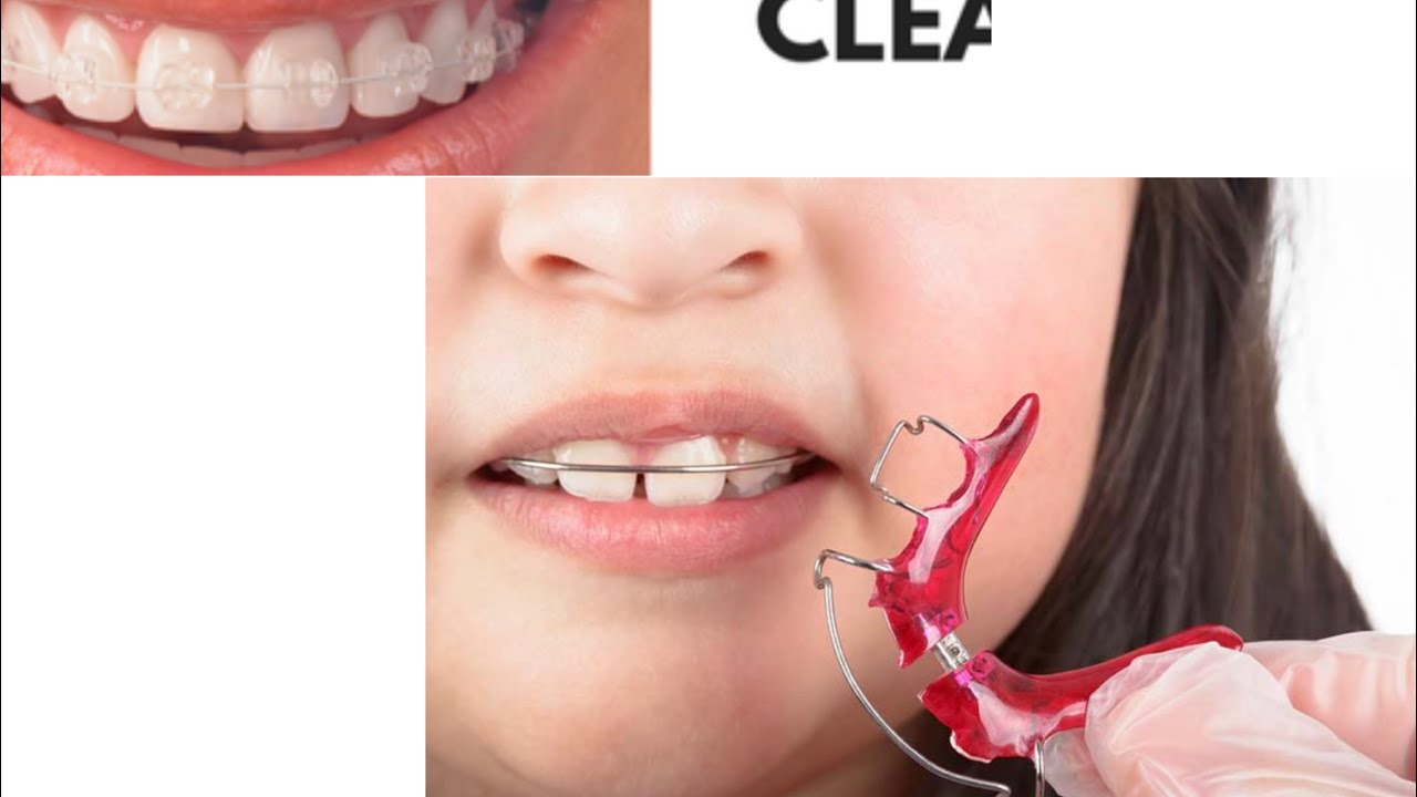 Why we use Retainers after orthodontic treatment#is it important? # watch full video # Reshma ...