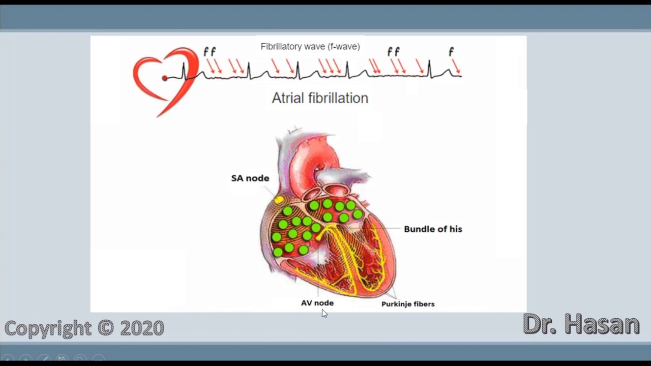 Flutter And Fibrillation Atrial Ventricular Flutter Fibrillation Flutter And Fibrillation Atrial Ventricular Flutter Fibrillation