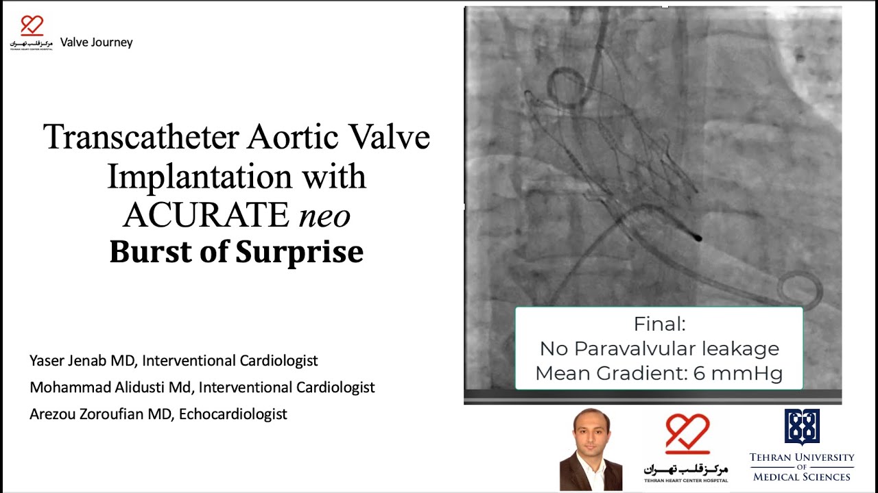 TAVI with the ACURATE neo transcatheter heart valve - YouTube