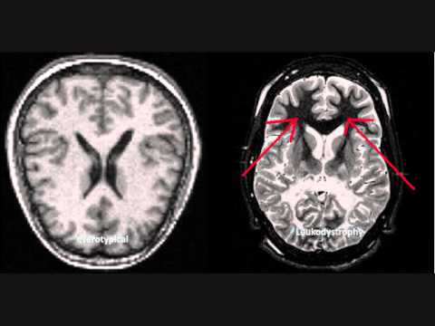 Leukodystrophy in a nutshell! - YouTube