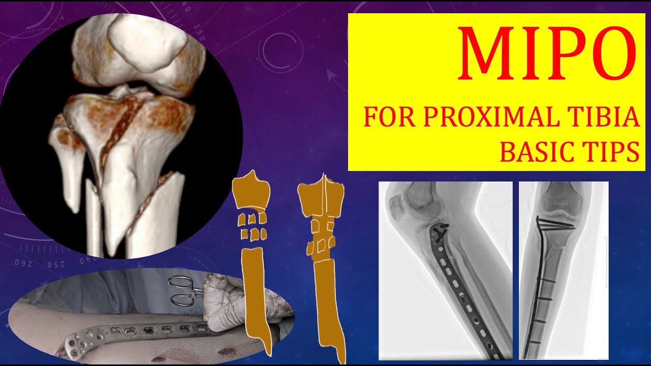 MIPO for Proximal Tibia Fractures: Stepwise Basics - YouTube