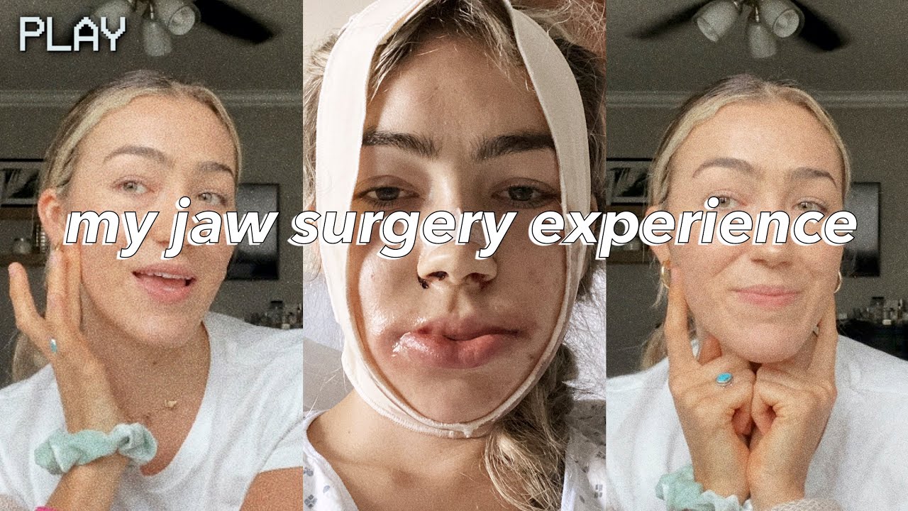 Underbite Surgery Pictures