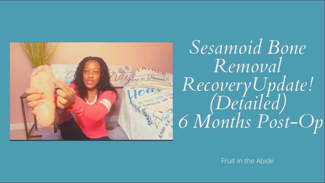 Sesamoid Bone Removal Recovery Update! 6 Months Post-Op ( detailed ...