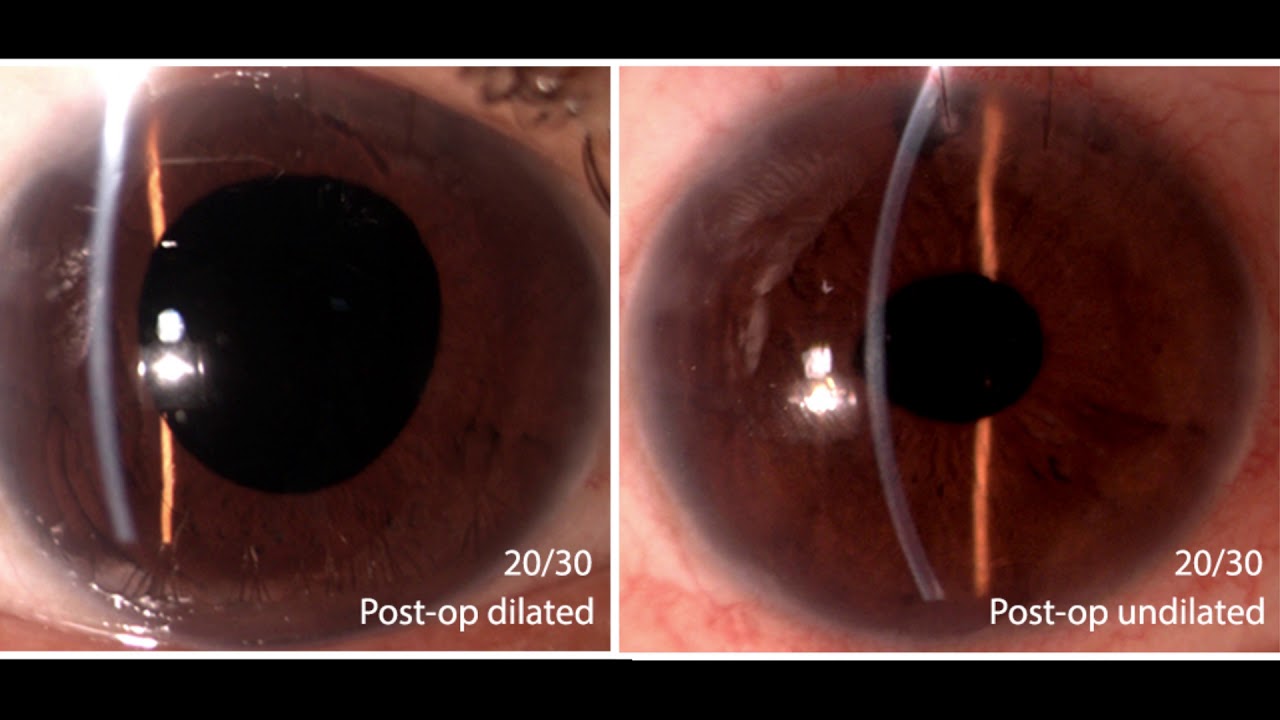 IOL replacement | When the going gets white !!! Replacing an Opaque IOL ...