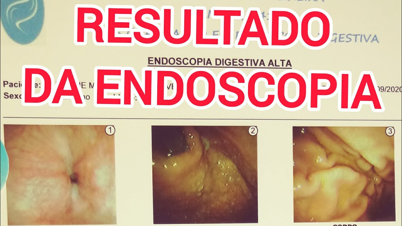 RESULTADO DE ENDOSCOPIA ALTA DIGESTIVA! - YouTube