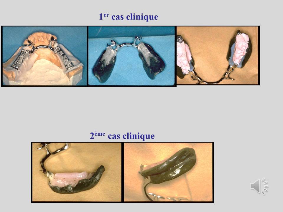 Chronologie d'un traitement de Prothèse Adjointe Partielle.wmv - YouTube
