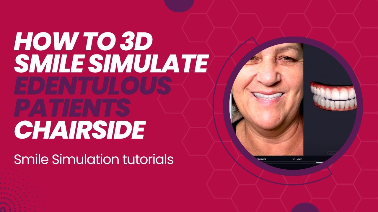 3D SMILE SIMULATION IMPLANT BRIDGE STEP-BY-STEP - YouTube
