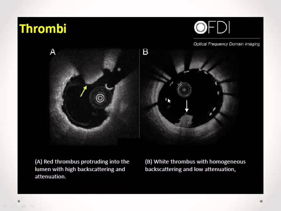 OCT Basics - YouTube