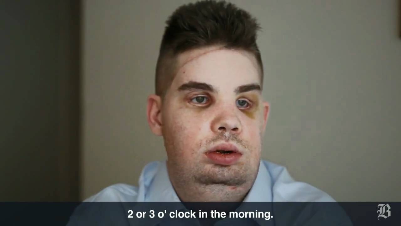 Face transplant patients become friends - YouTube