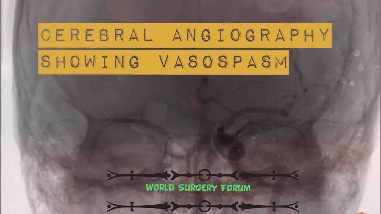 Cerebral Angiography Showing Vasospasm | Dr Sandeep Moolchandani - YouTube