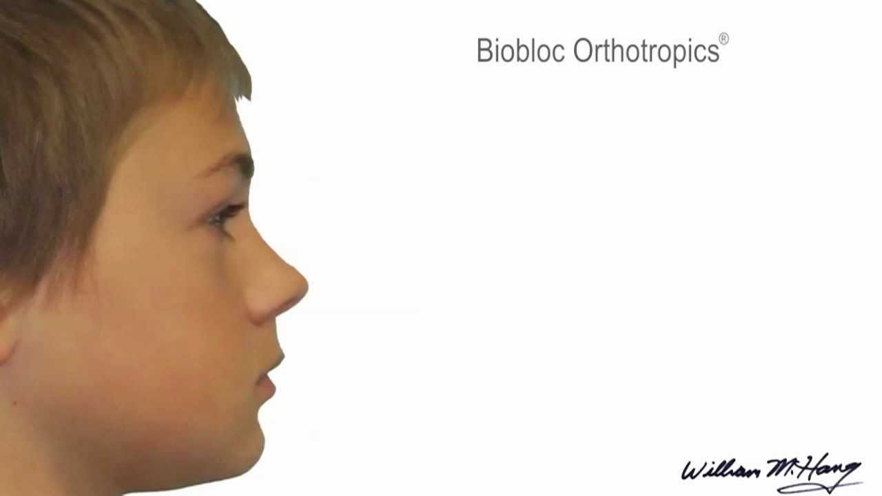 Morph of Dr. Hang's Biobloc Orthotropic ® Treatment - YouTube