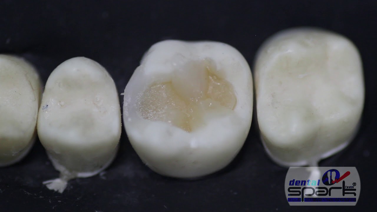 Composite - Class II - Upper 6 - YouTube