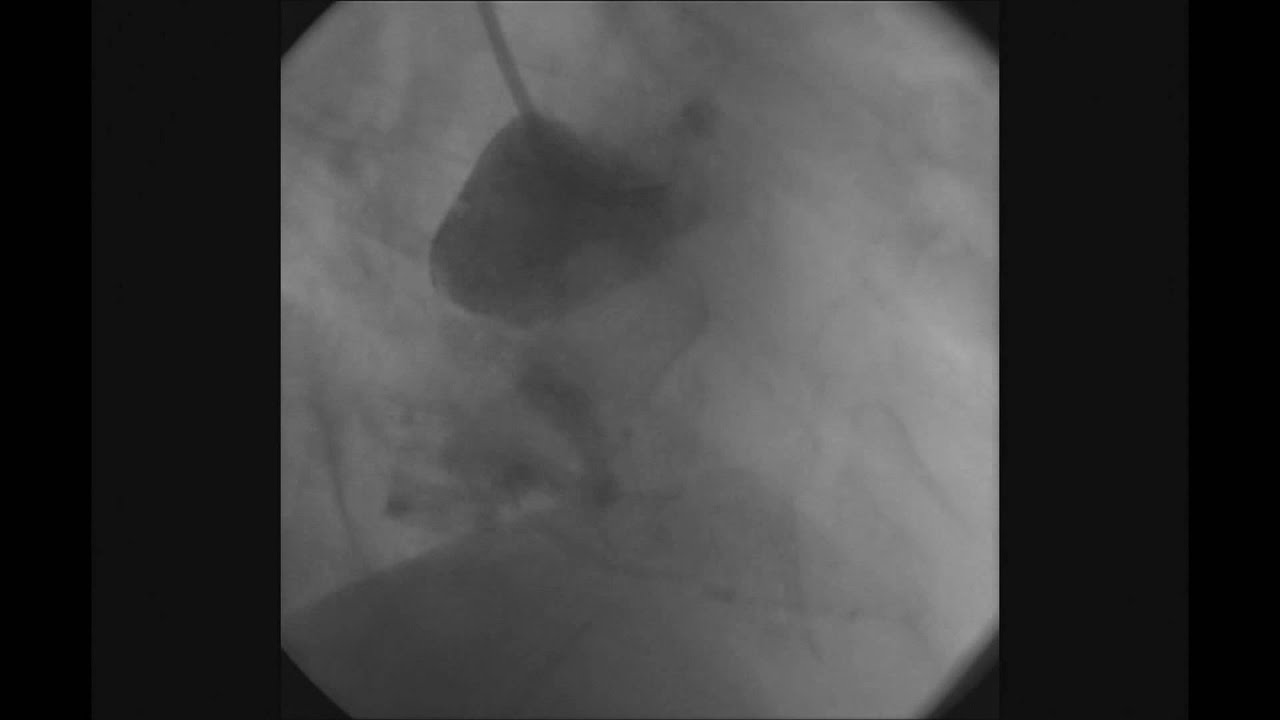 Pericardium Covered Stent in huge aneurysm - YouTube