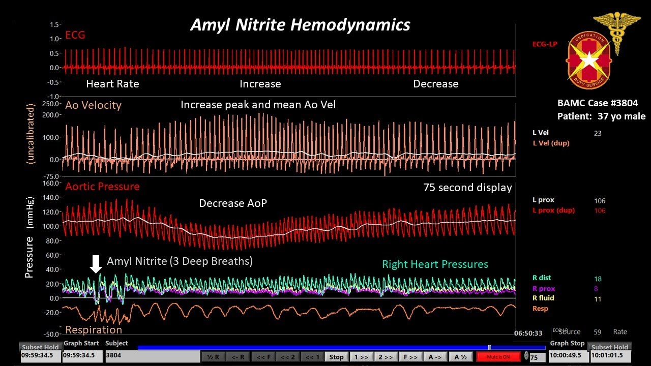 BAMC 3804 Hemodynamic Response to Amyl Nitrite Inhalation - YouTube