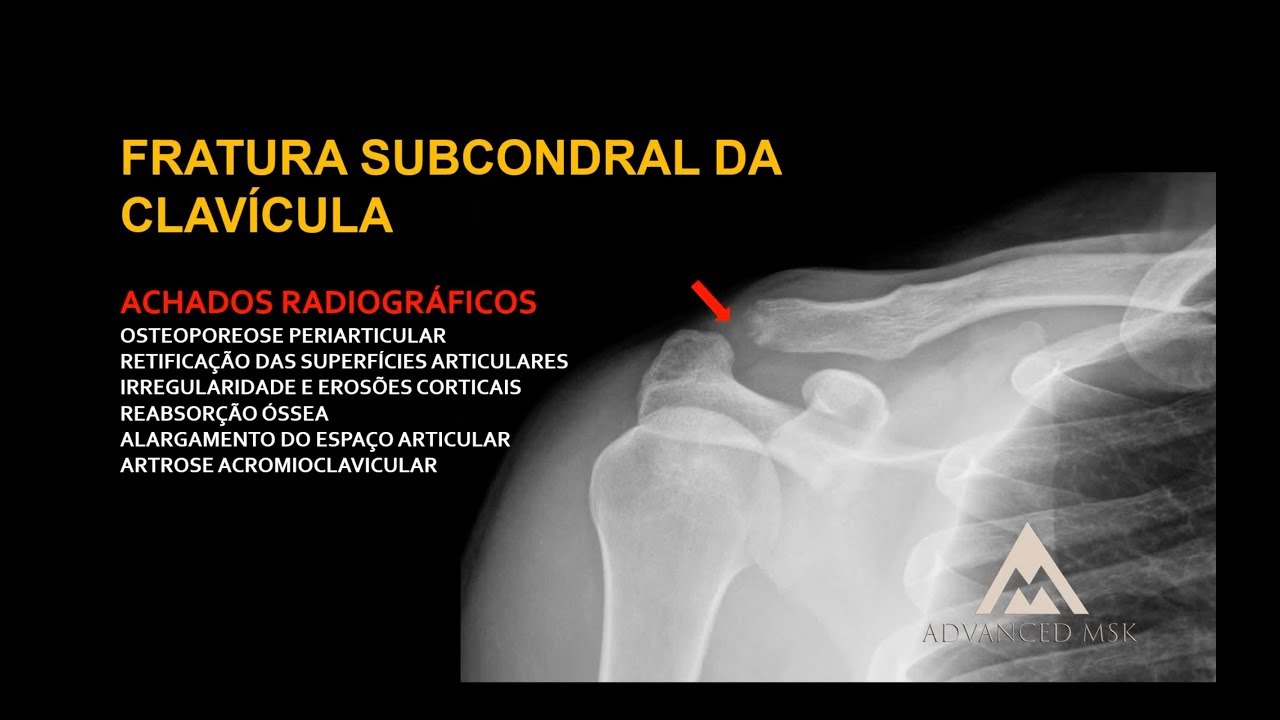 Fratura Distal Da Clavicula PDF) Fratura Da Região Distal Da
