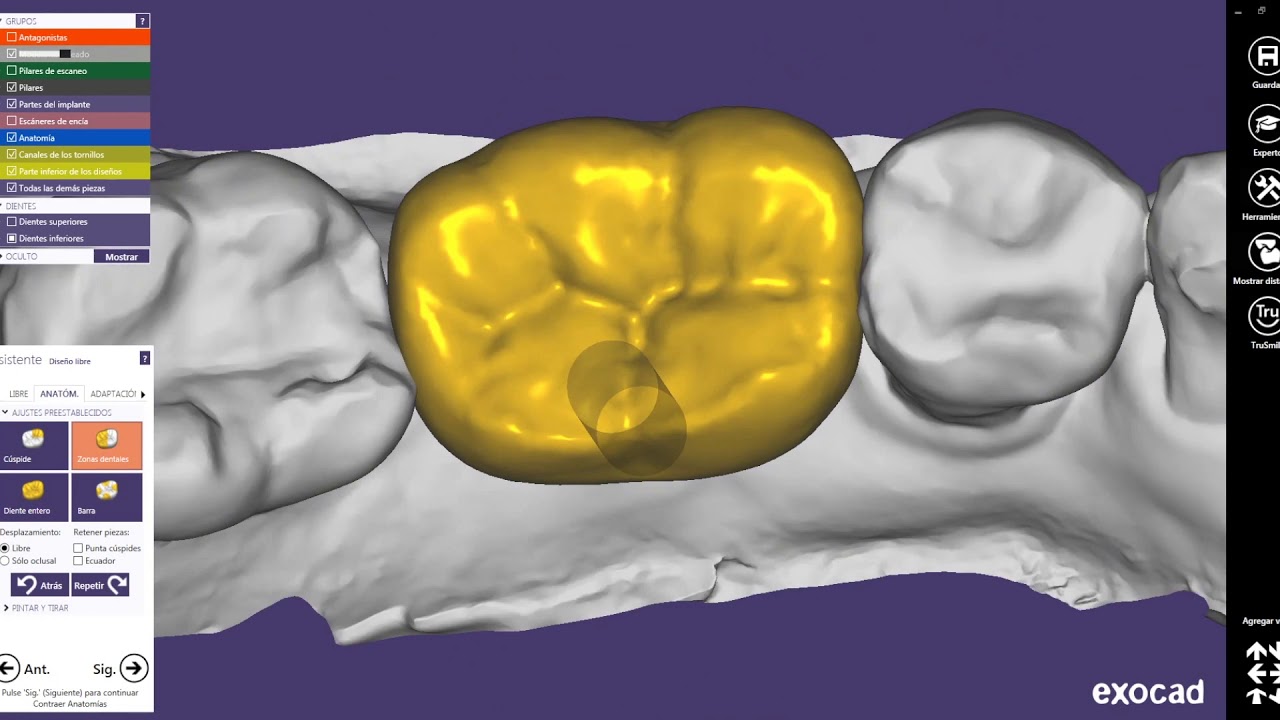 Implant Crown Design Exocad - YouTube