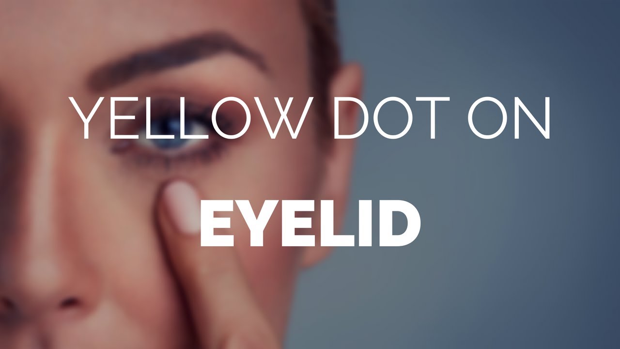 Yellow Dot On Eyelid Is It The Start Of Xanthelasma YouTube yellow-dot-on-eyelid-is-it-the-start-of-xanthelasma-youtube