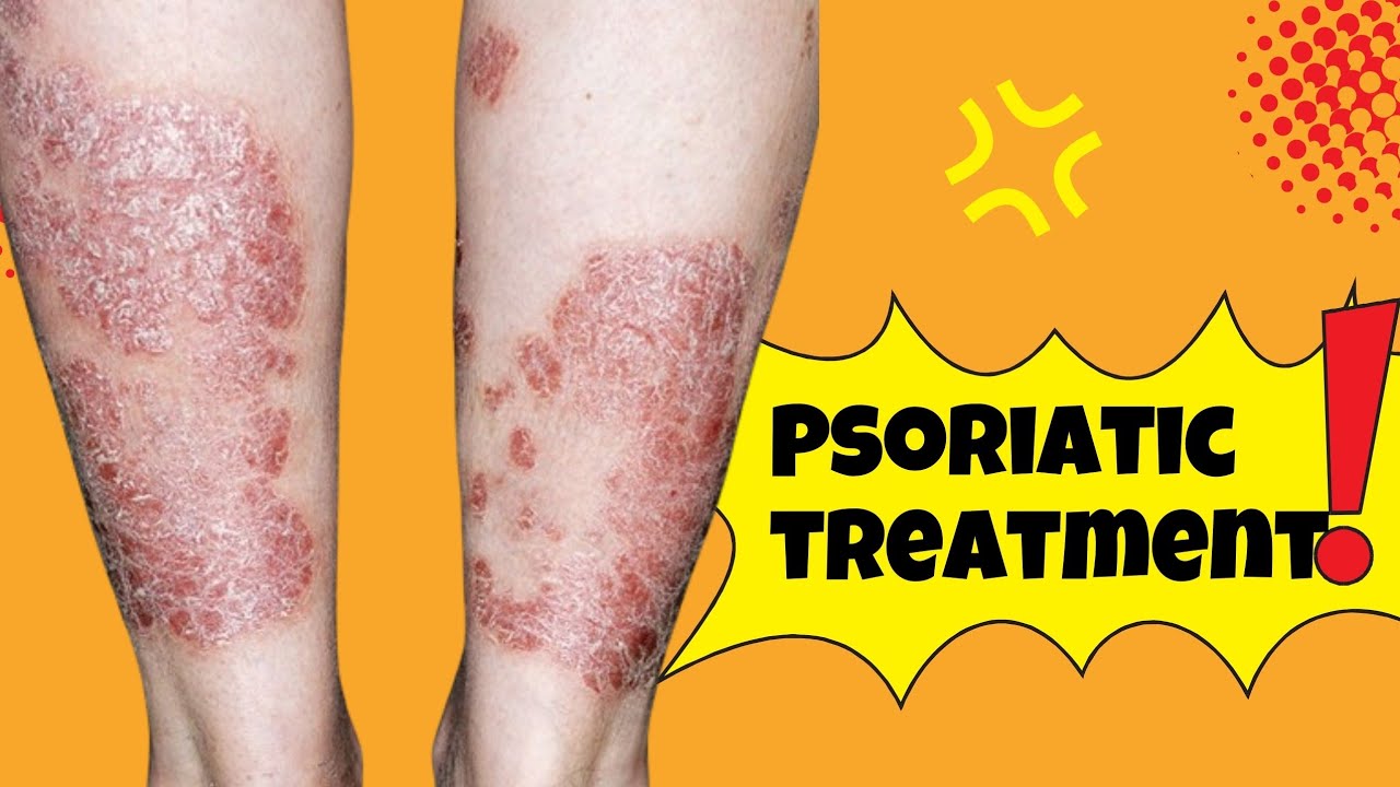 The best treatment for psoriasis!!!! #medicinalherbs #plant - YouTube