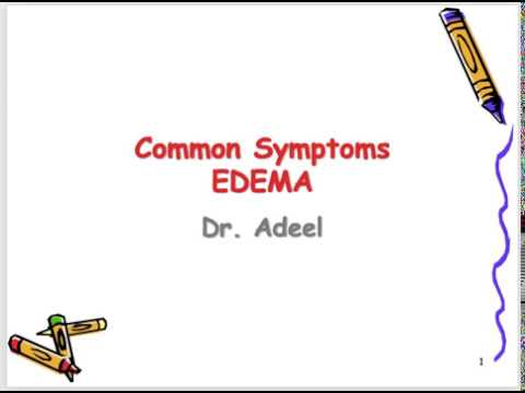 Edema, Localized and Generalized, Pitting and Non pitting - YouTube