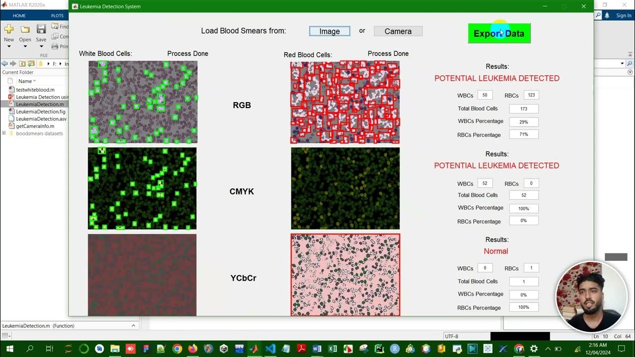 Leukemia Cancer detection project source code - YouTube