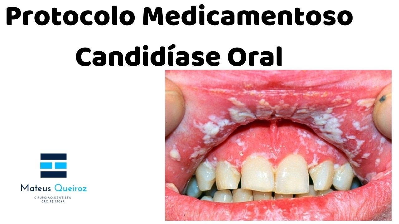 Candidiase Na Lingua Tratamento - FDPLEARN