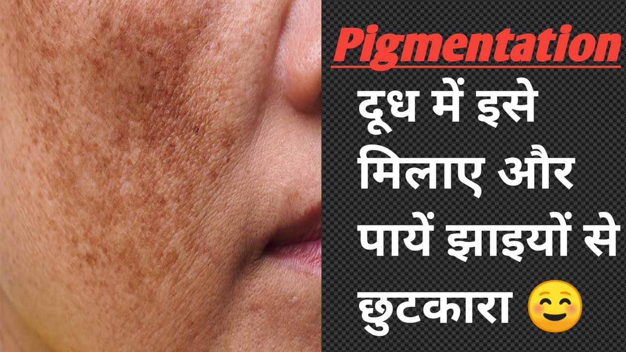How to clear skin pigmentation || Pigmentation treatment ghar pe # ...