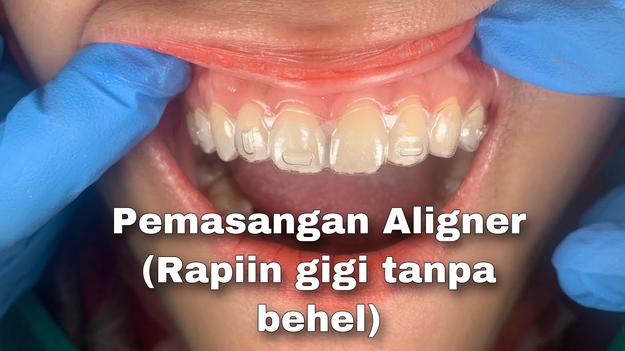 Prosedur Pemasangan Aligner / rapiin gigi tanpa behel / attachment aligner - YouTube