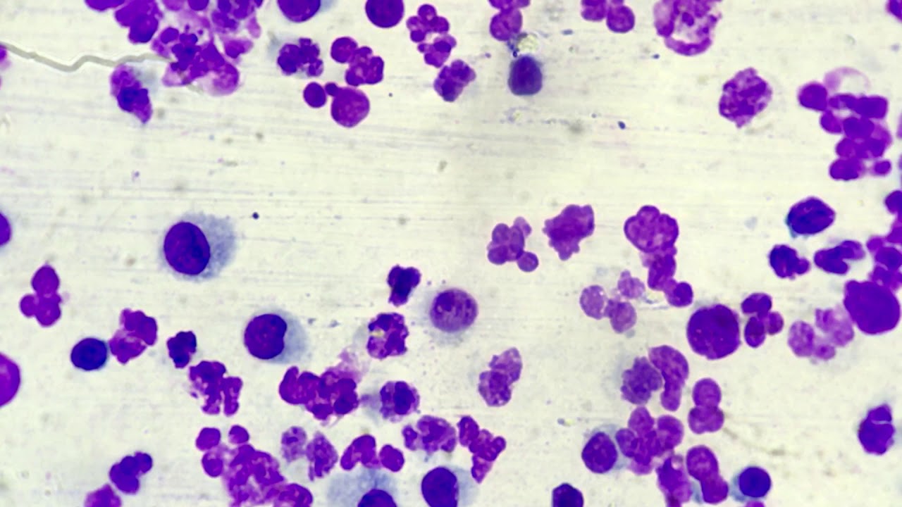 Pyothorax | pleural effusion cytology - YouTube