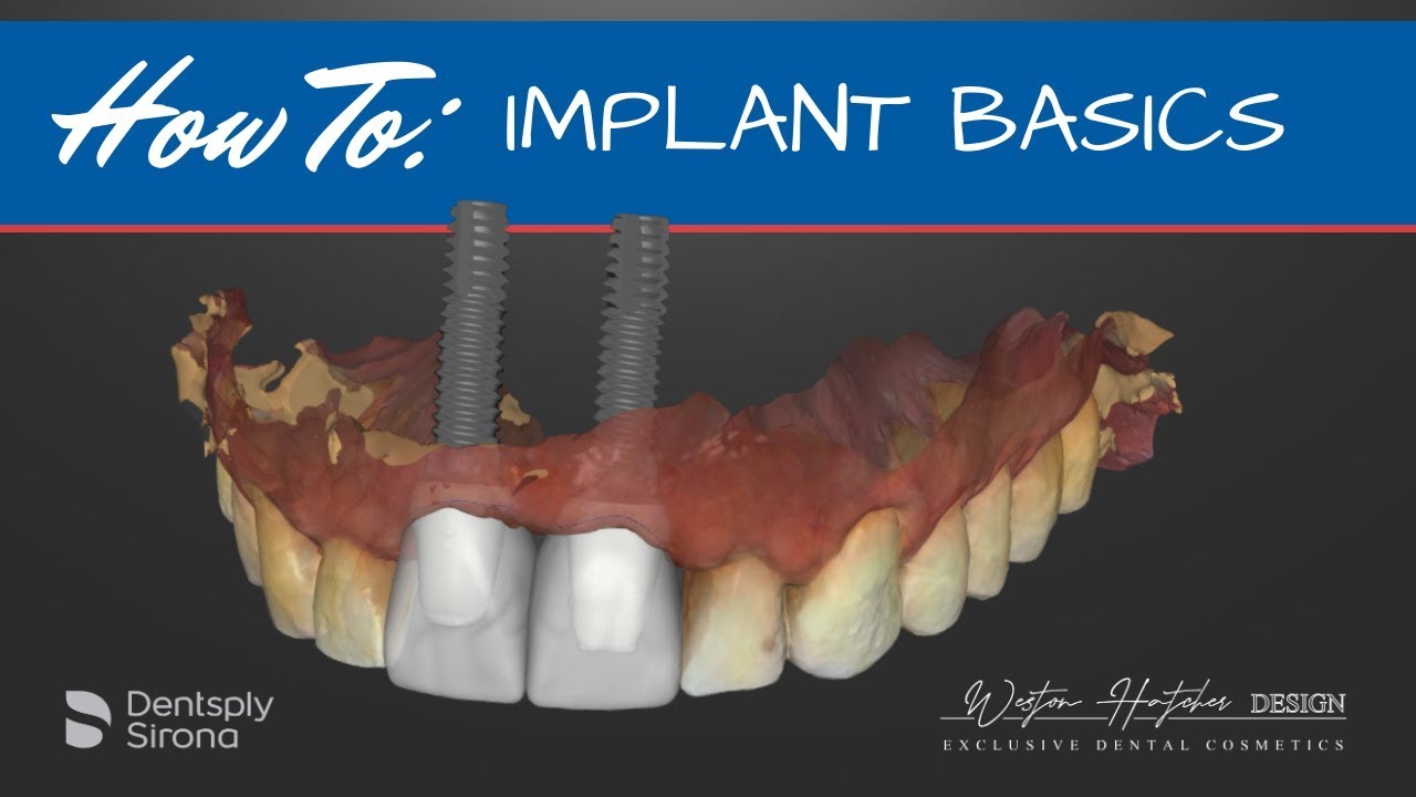 Step-by-Step Implant Design Process - YouTube