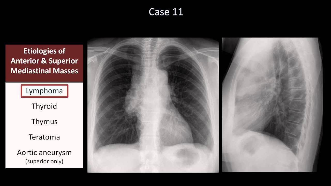 How to Interpret a Chest X Ray Lesson 10 Self Assessment Part 2 - YouTube