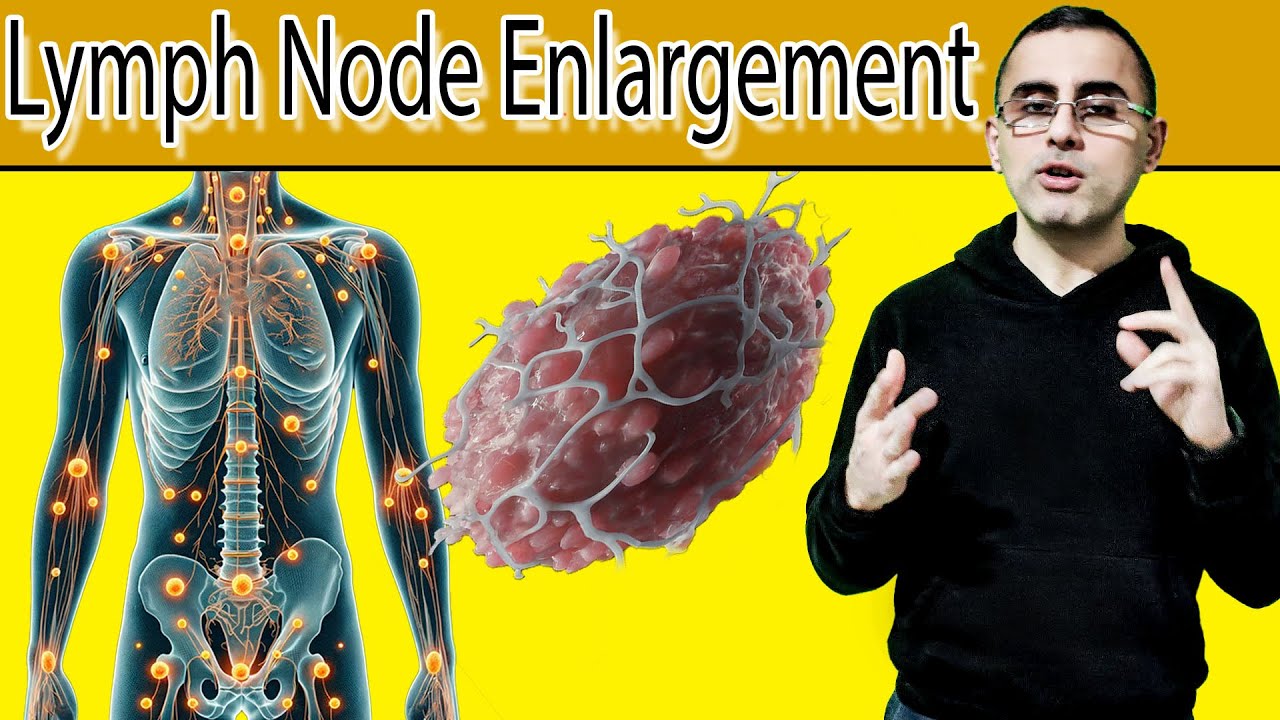 Lymph Node Enlargement Causes and Approach - YouTube