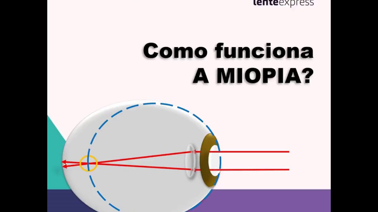 COMO FUNCIONA A MIOPIA - YouTube