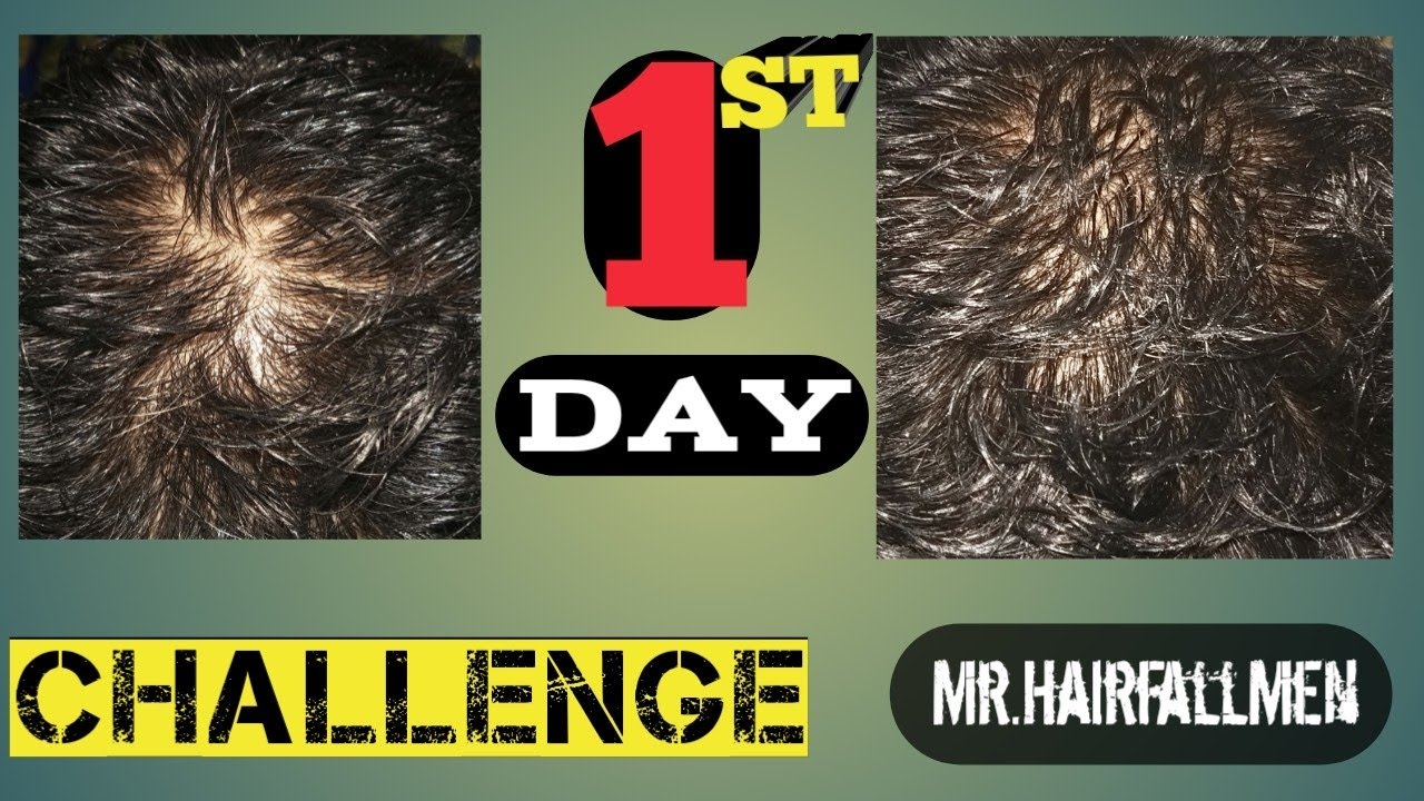Hairfall men Introduce Video Hair grow jurney start 1st Video.Mr ...
