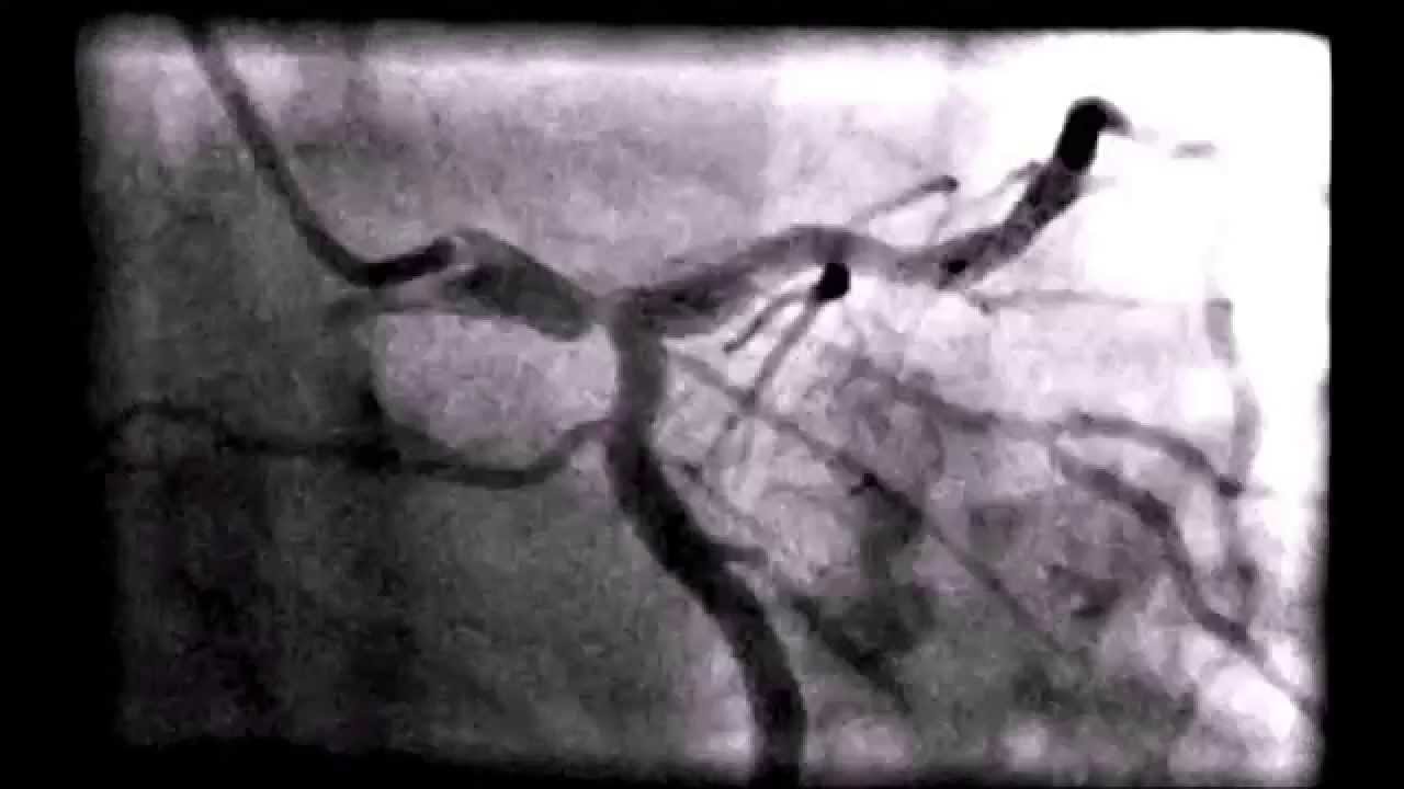 Critical stenosis of distal left main coronary artery - YouTube