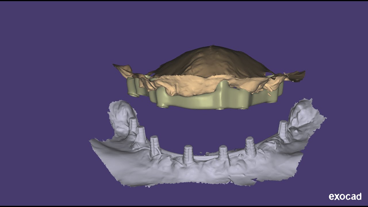 All on x titanium bar designing in Exocad elefsina1 - YouTube