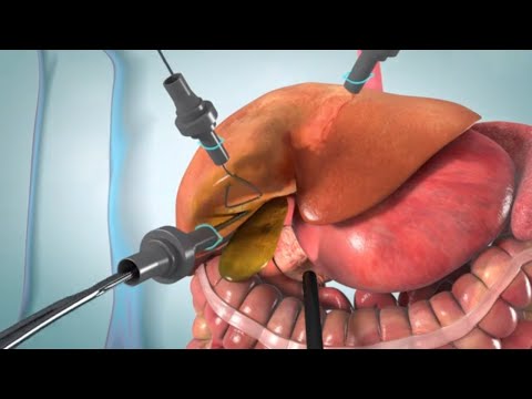 Laparoscopic and open cholecystectomy surgery (animation)