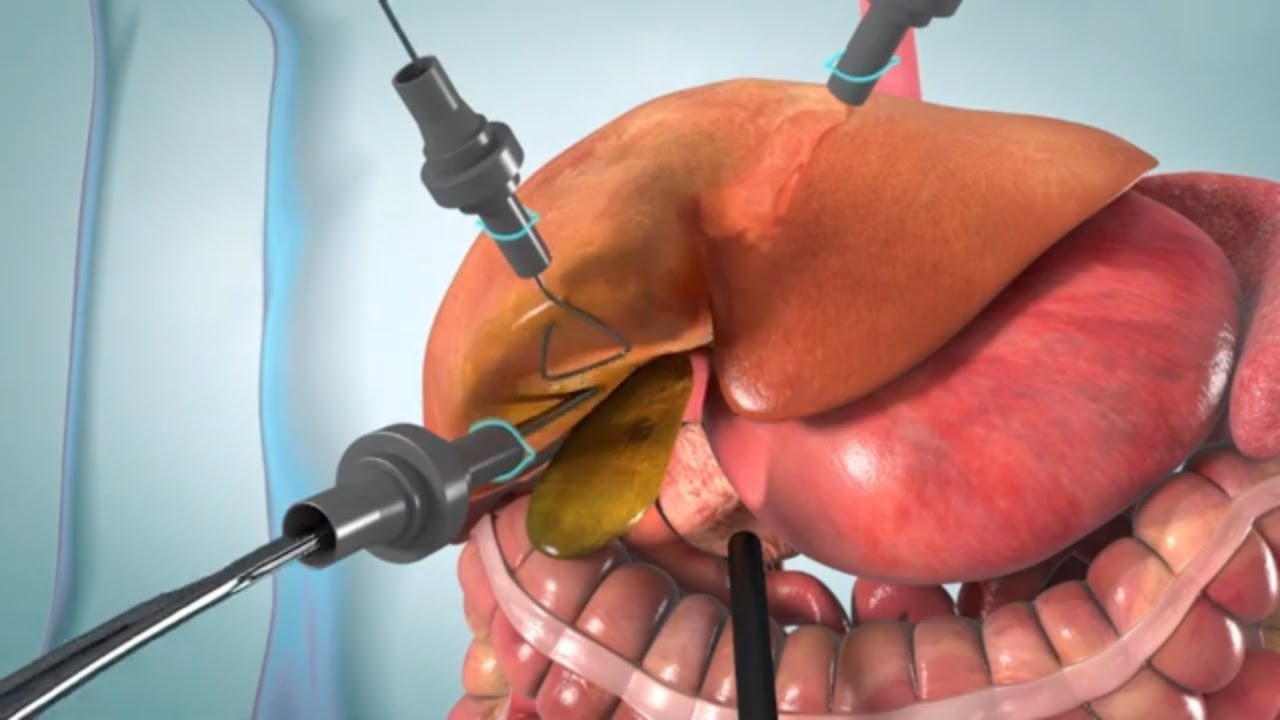 Laparoscopic and open cholecystectomy surgery (animation) - YouTube