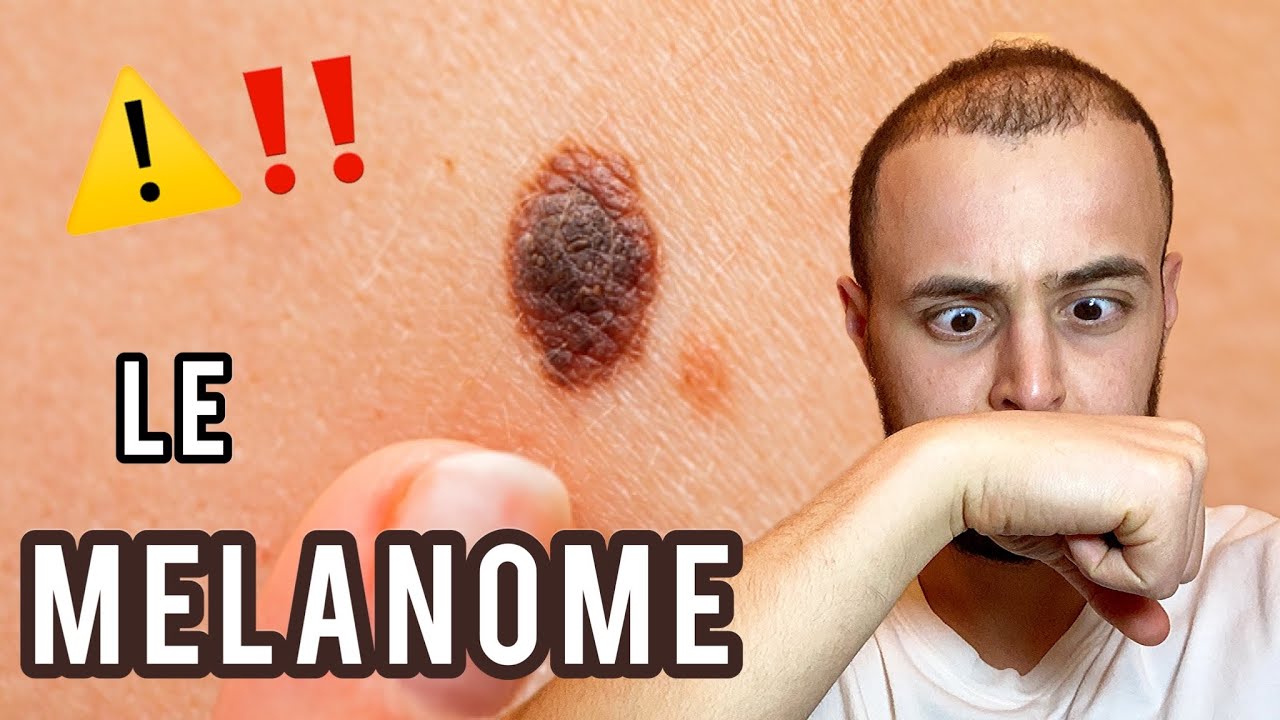 LE MÉLANOME : UN DES CANCERS LES PLUS REDOUTABLES ! COMMENT LE REPÉRER ...