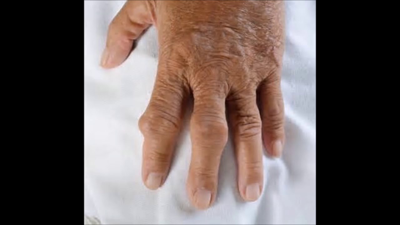 Things To Help Prevent Gout - Prevent Gout Flare Up - YouTube