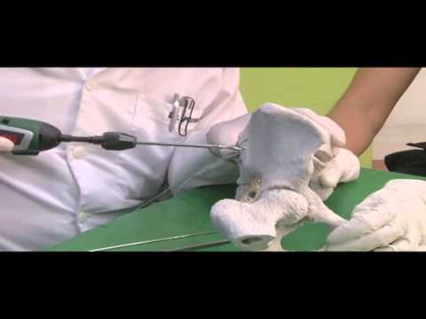 Tigh Rope en Traumas y Ortopedia (Dr. Celso Pedraza Galvis) -UIS 2014 ...