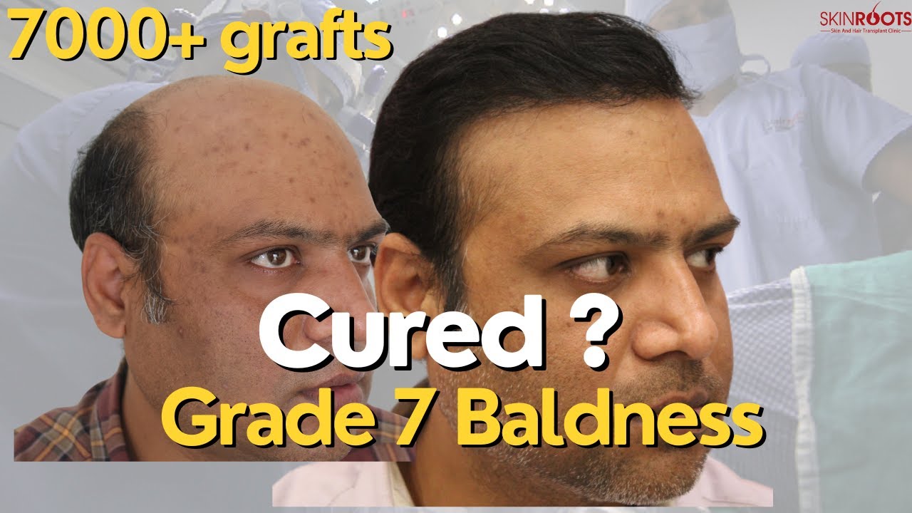 Unbelievable hair transplant result in Grade 7 Baldness | Hair transplant before and after ...