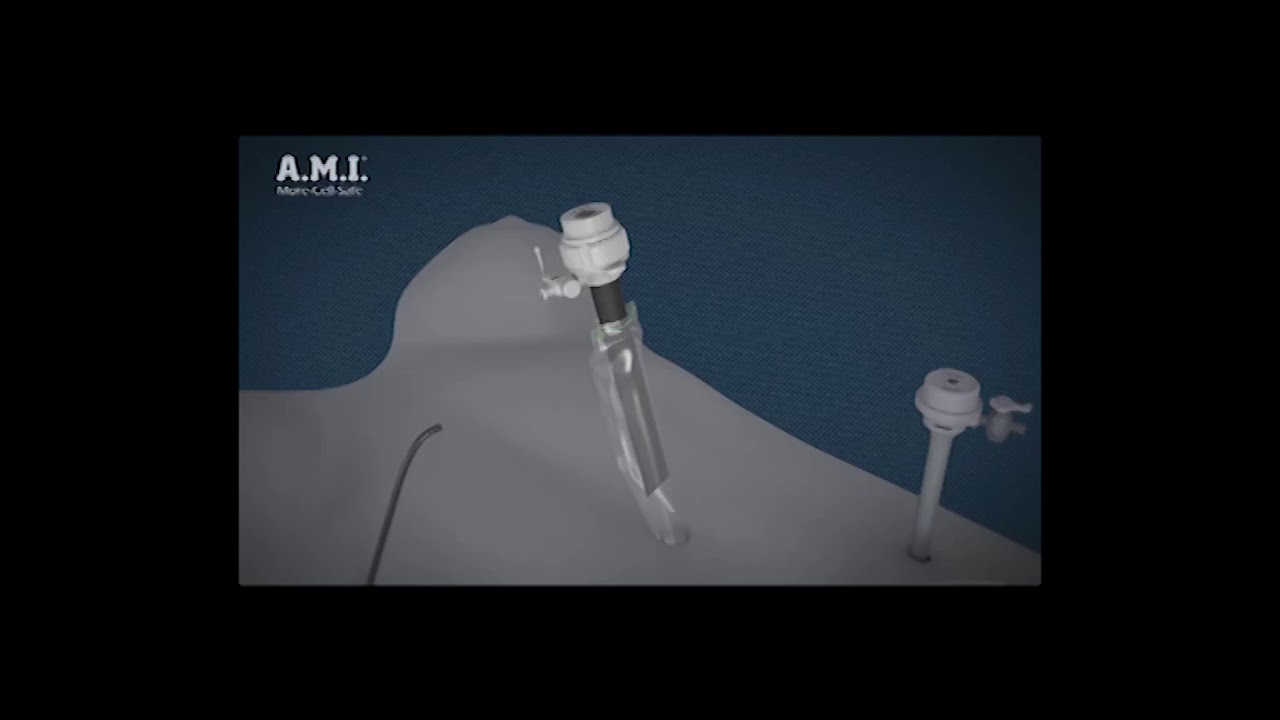 Contained in bag morcellation for laparoscopic myomectomy - YouTube