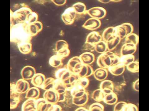 A Chronic Lyme disease patient's blood under a microscope - YouTube